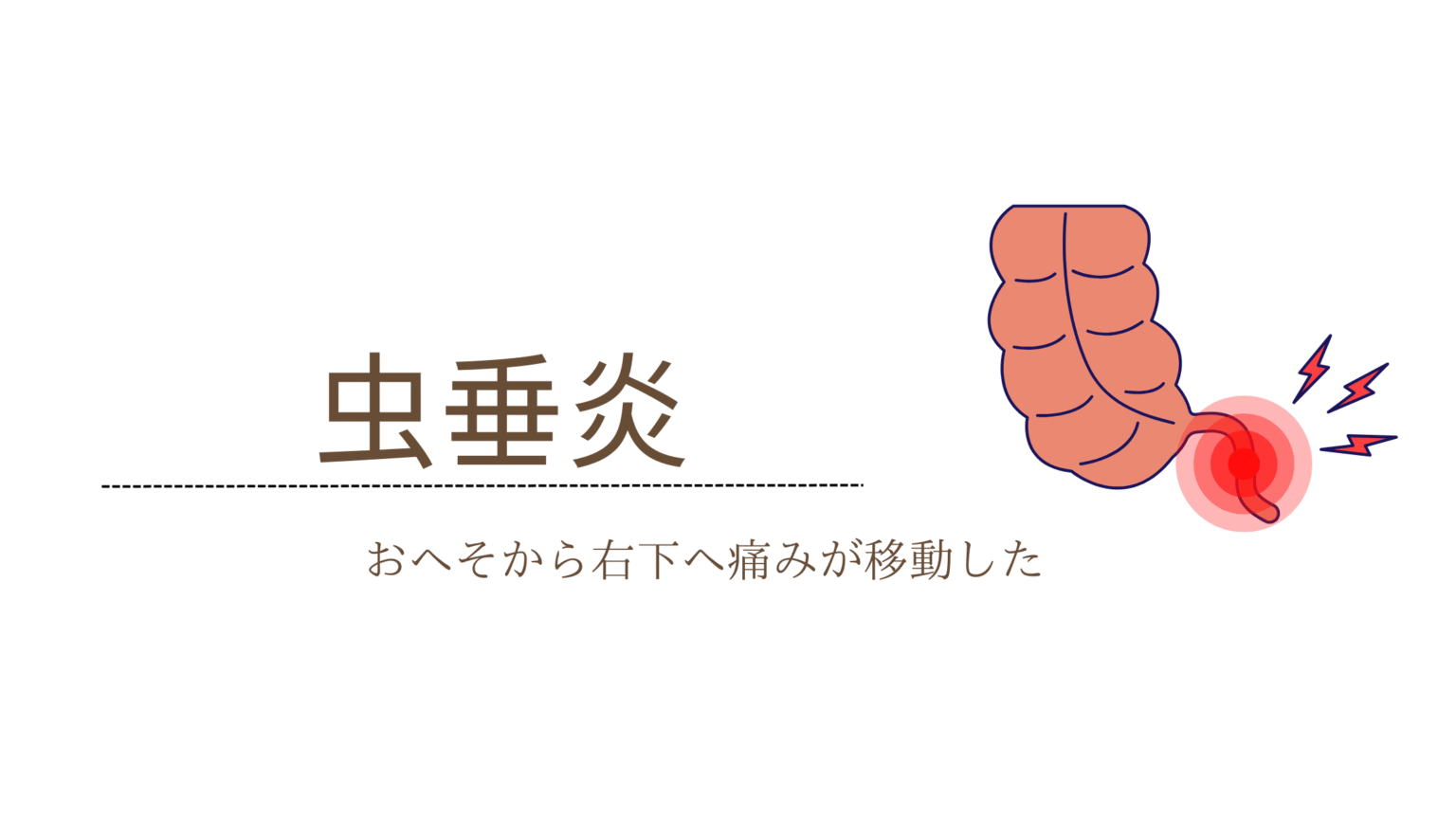 虫垂炎とは？ みどりのふきたクリニック 1502